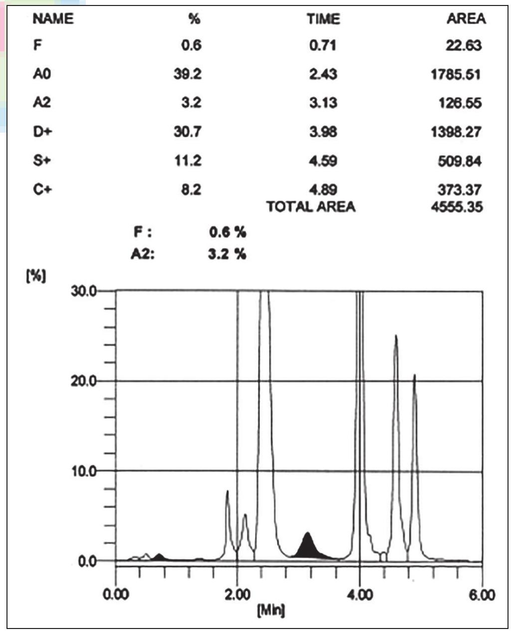 Figure 3 - from Diagnosis of a rare double heterozygous Hb D