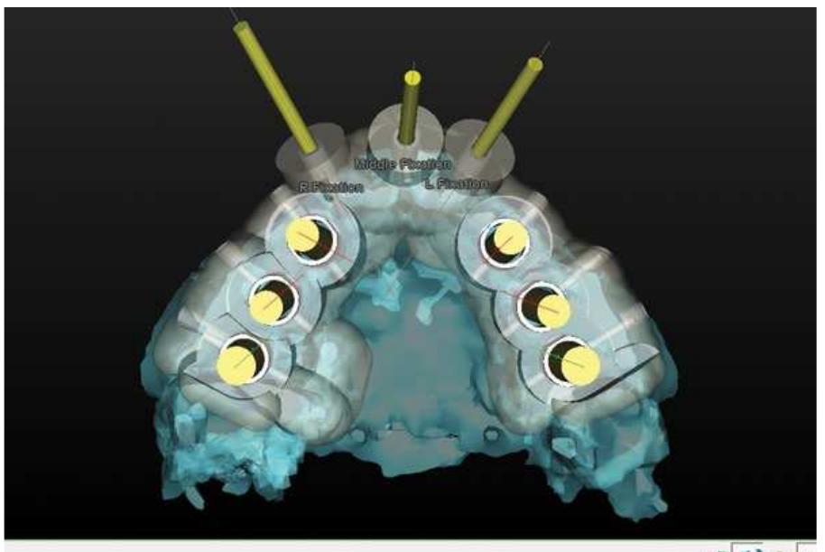 Virtual maxillary surgical guide with implant trajectories