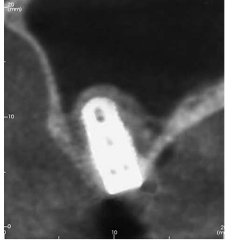 Post-op cone-beam computed tomography (cbct) revealing
