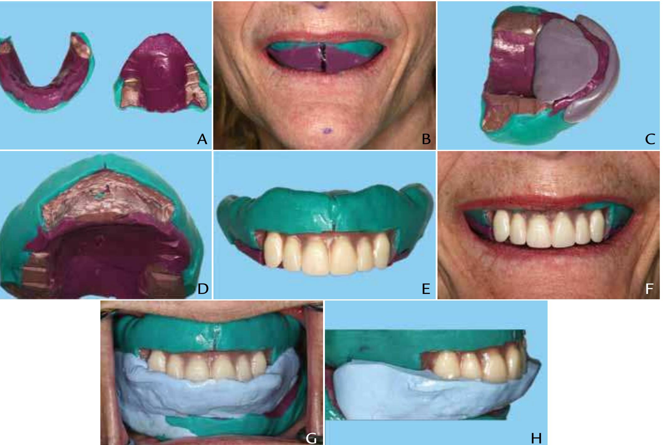 Bja, maxillary and mandibular impressions trimmed so