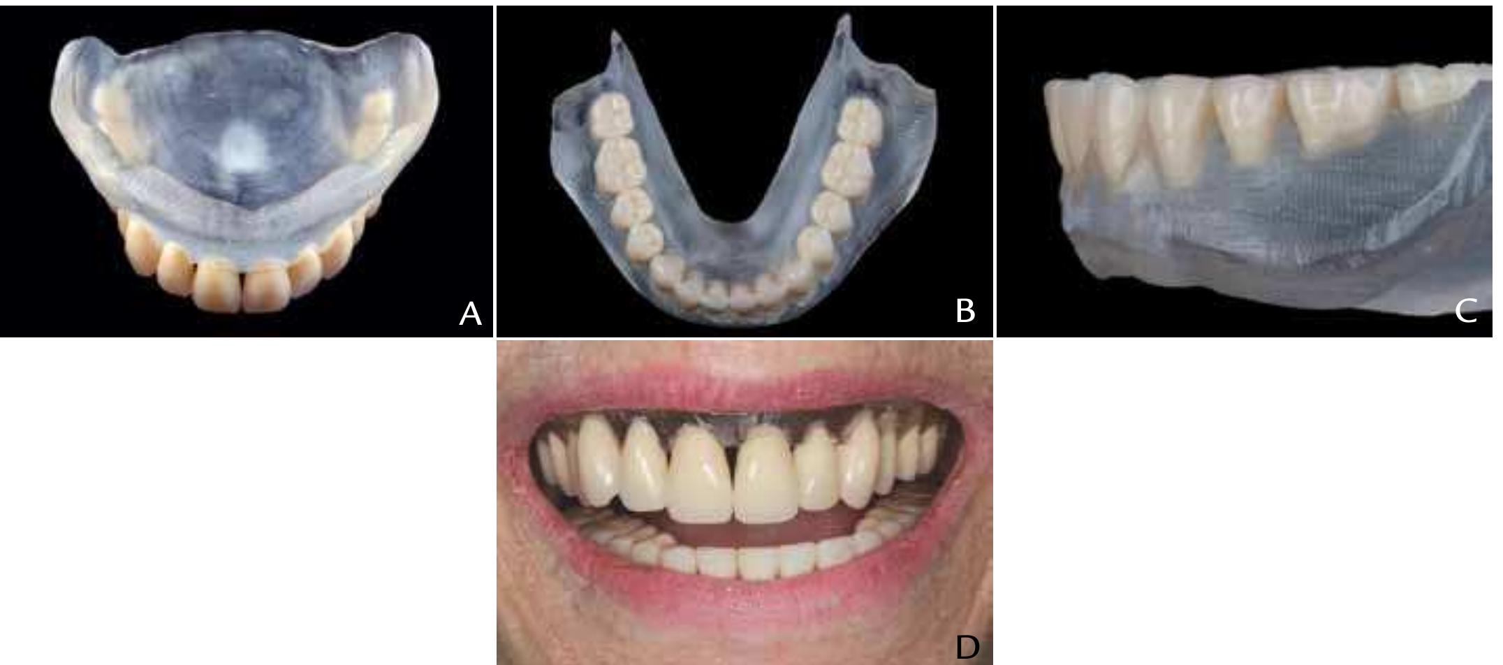 A, maxillary proof of concept denture milled from clear