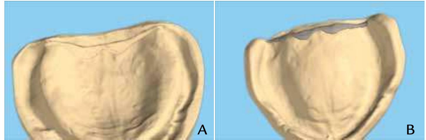 a, virtual maxillary cast with posterior palatal seal