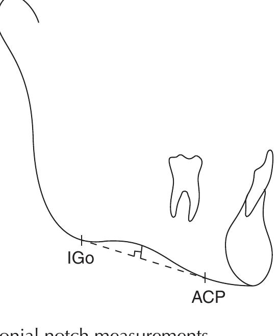 Figure 1 - Dimensional differences in mandibular antegonial