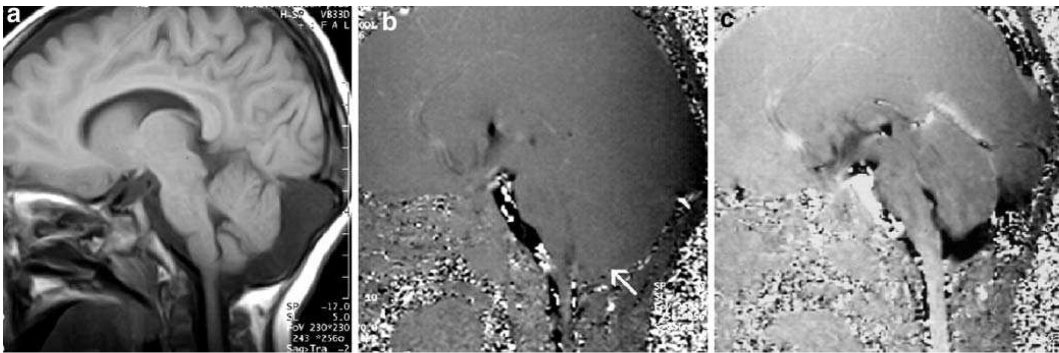 Figure 7 - from Evaluation of CSF flow patterns of posterior