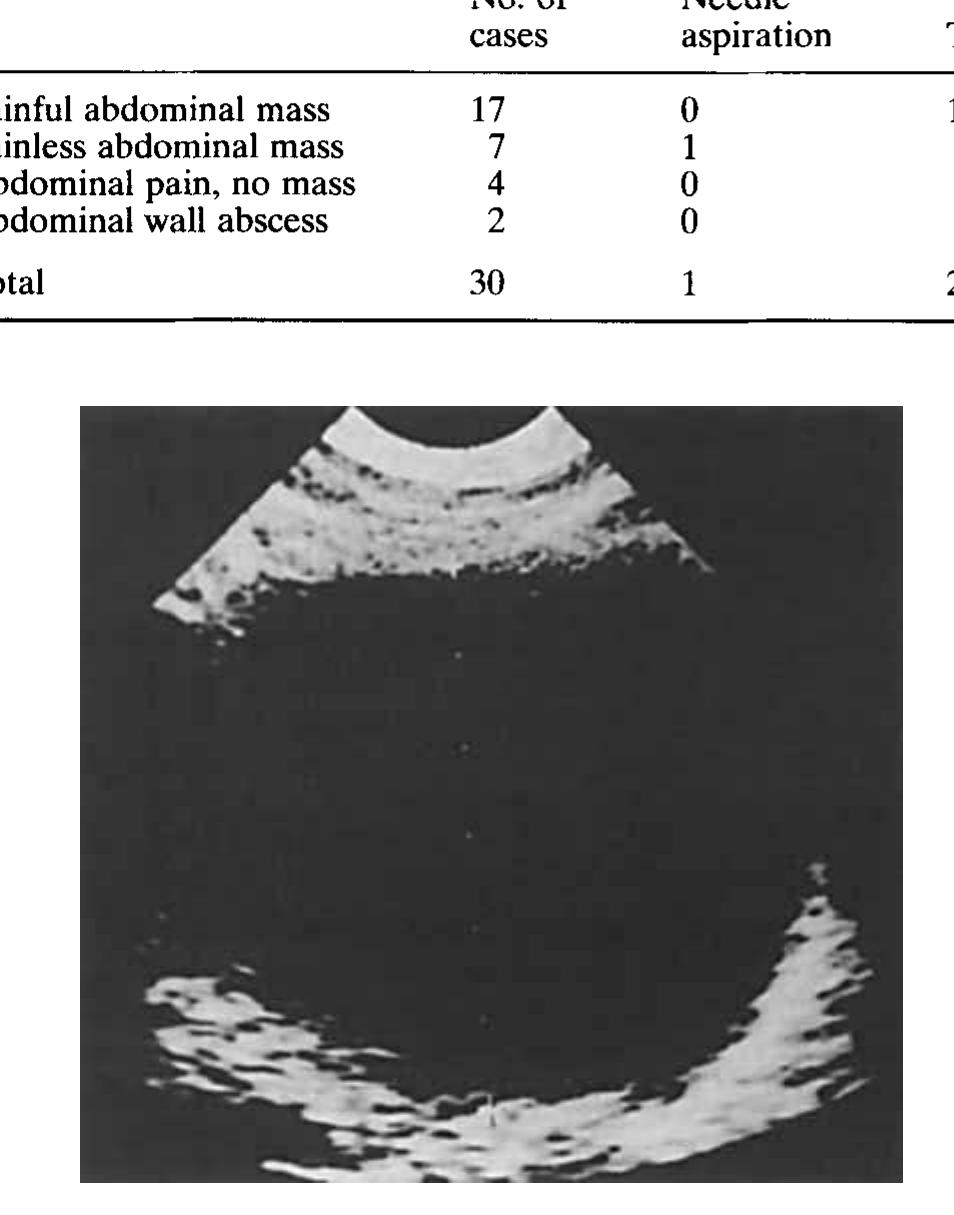 Ultrasonographic image of rectus sheath haematoma: fusiform