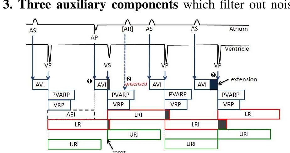 Pacemaker timing cycles. 2. atrio-ventricular interval (avi)
