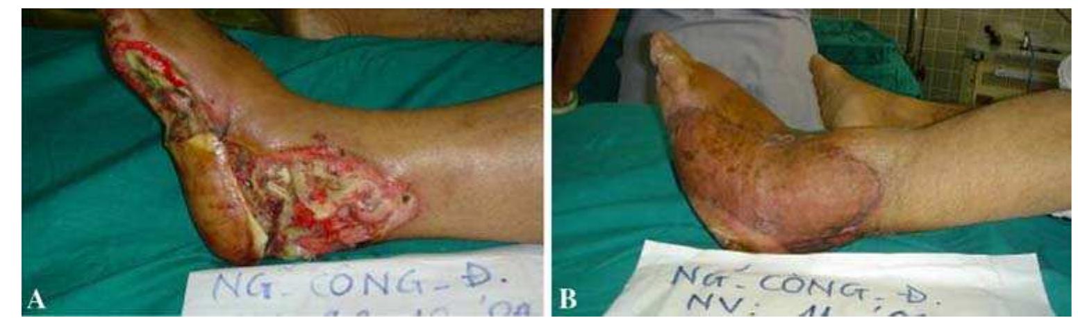 Scapular flap, serratus anterior flap, scapular bone flap).