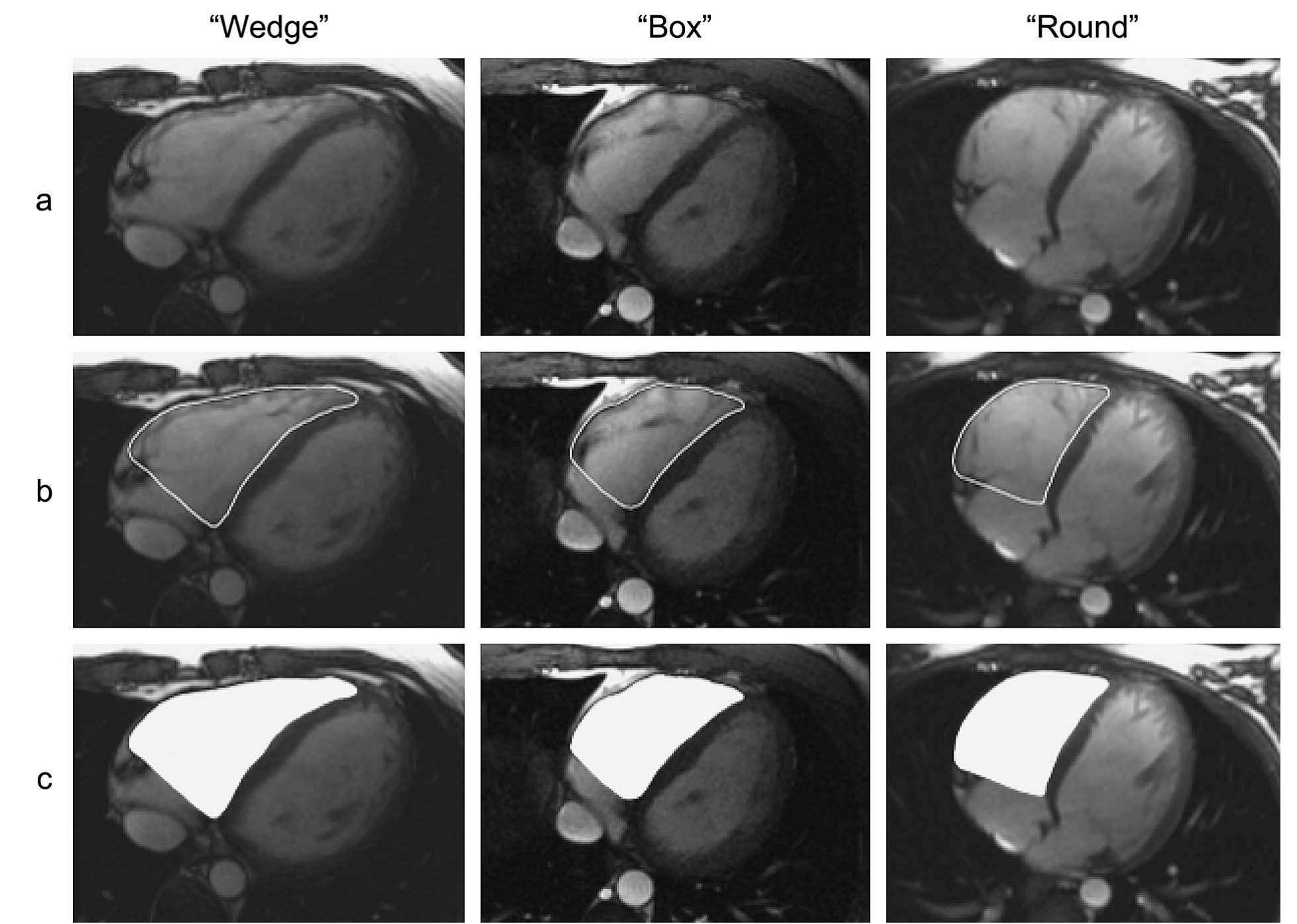 Figure 1 - from Right Ventricle Shape and Contraction
