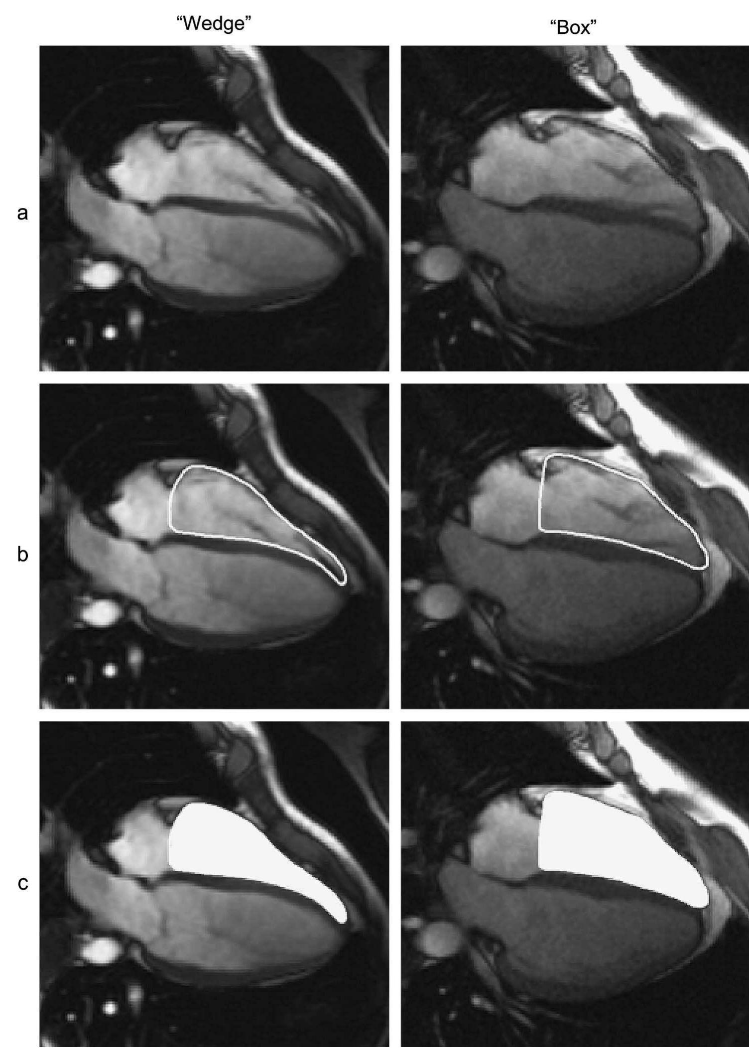 Figure 2 - Right Ventricle Shape and Contraction Patterns