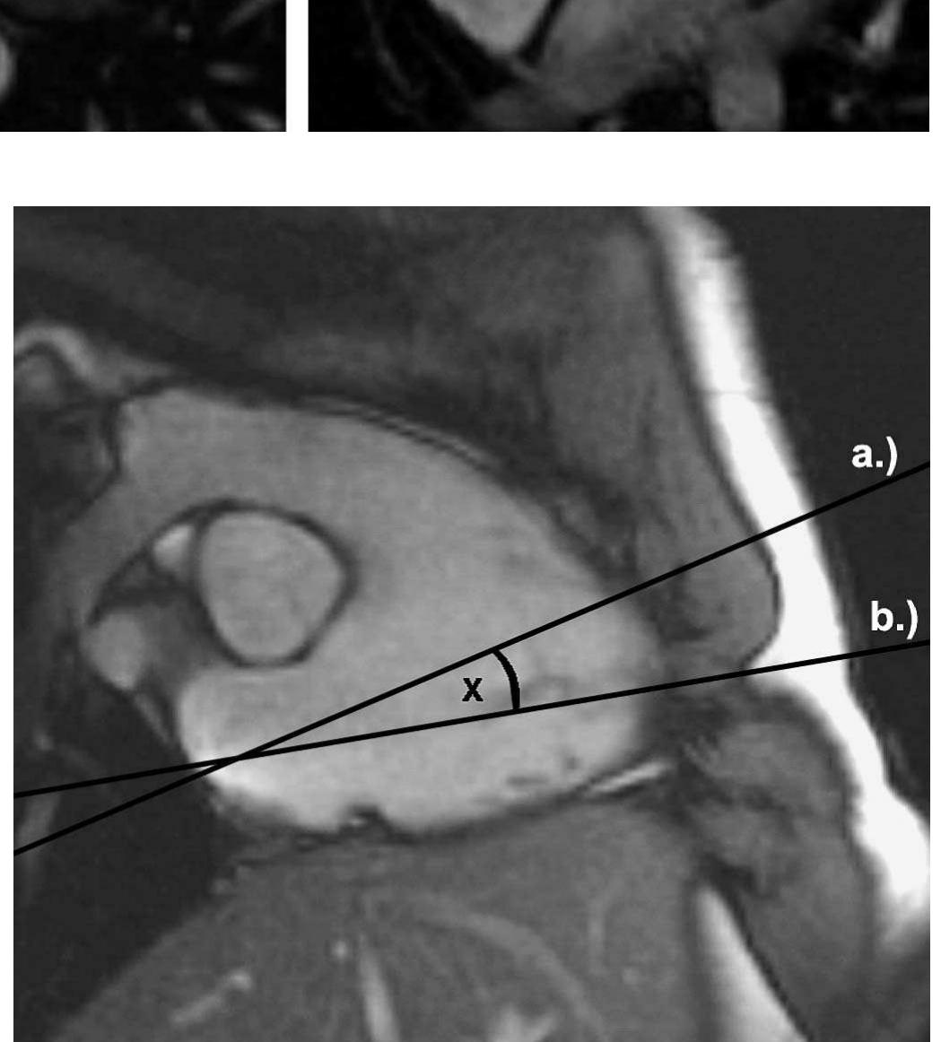 Right ventricle vertical long-axis mri scan (repeti- tion