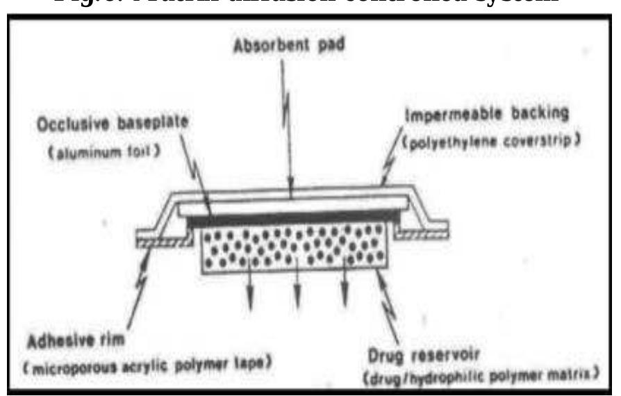 4, micro reservoir type or micro sealed dissolution: