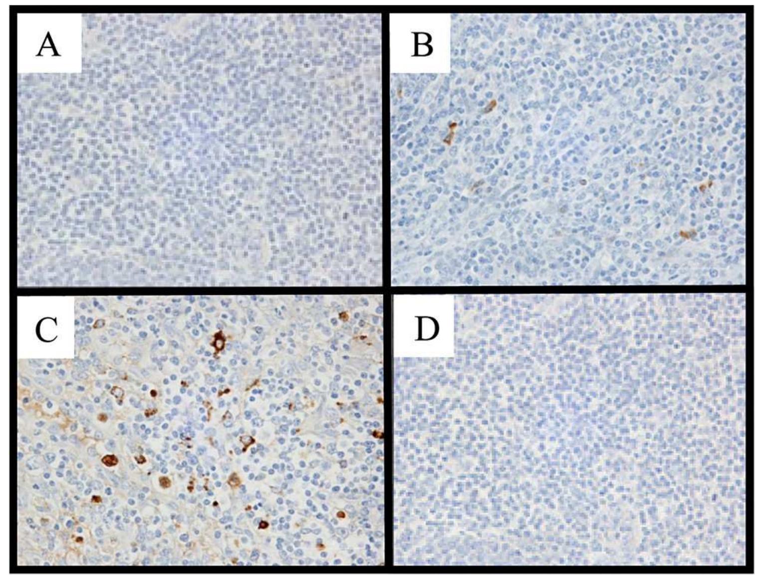 Pcv2 antigen in lymph nodes. ihc staining in