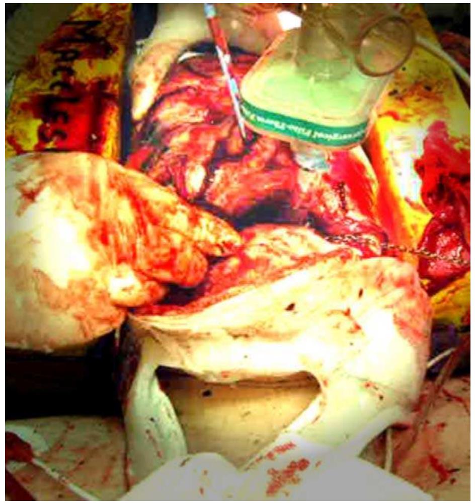 Control of profuse midface bleeding, using bite blocks,