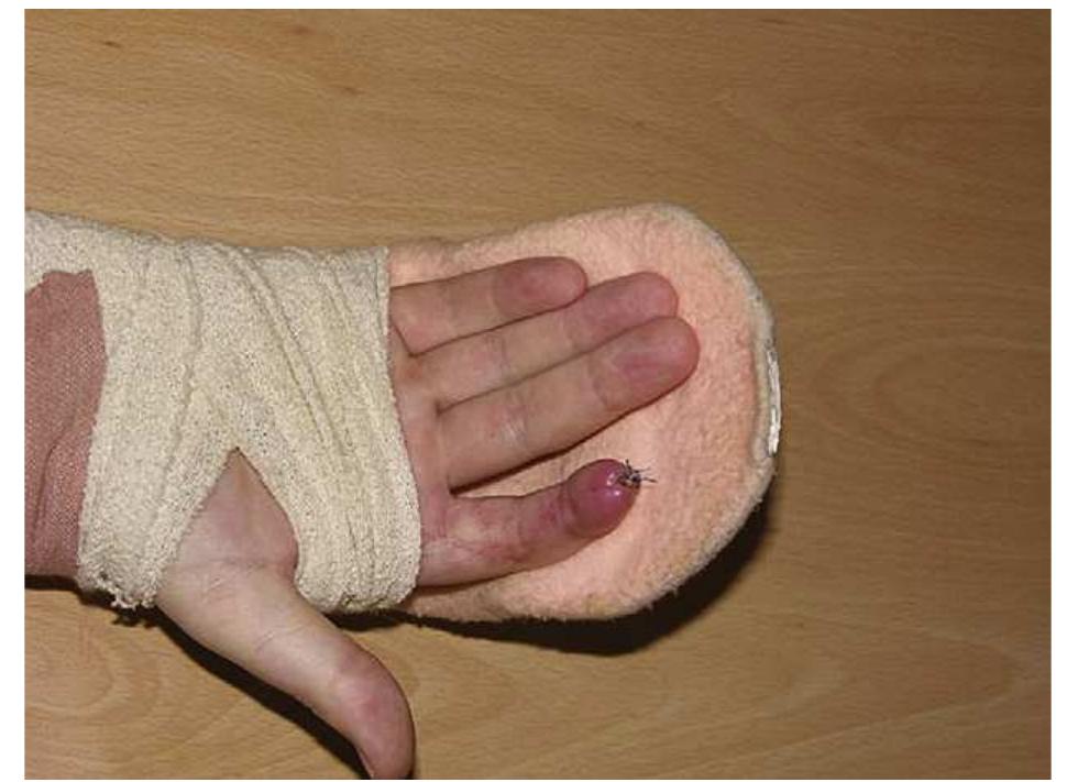 (PDF) A modification of the Bruner incision for the hand and review of ...