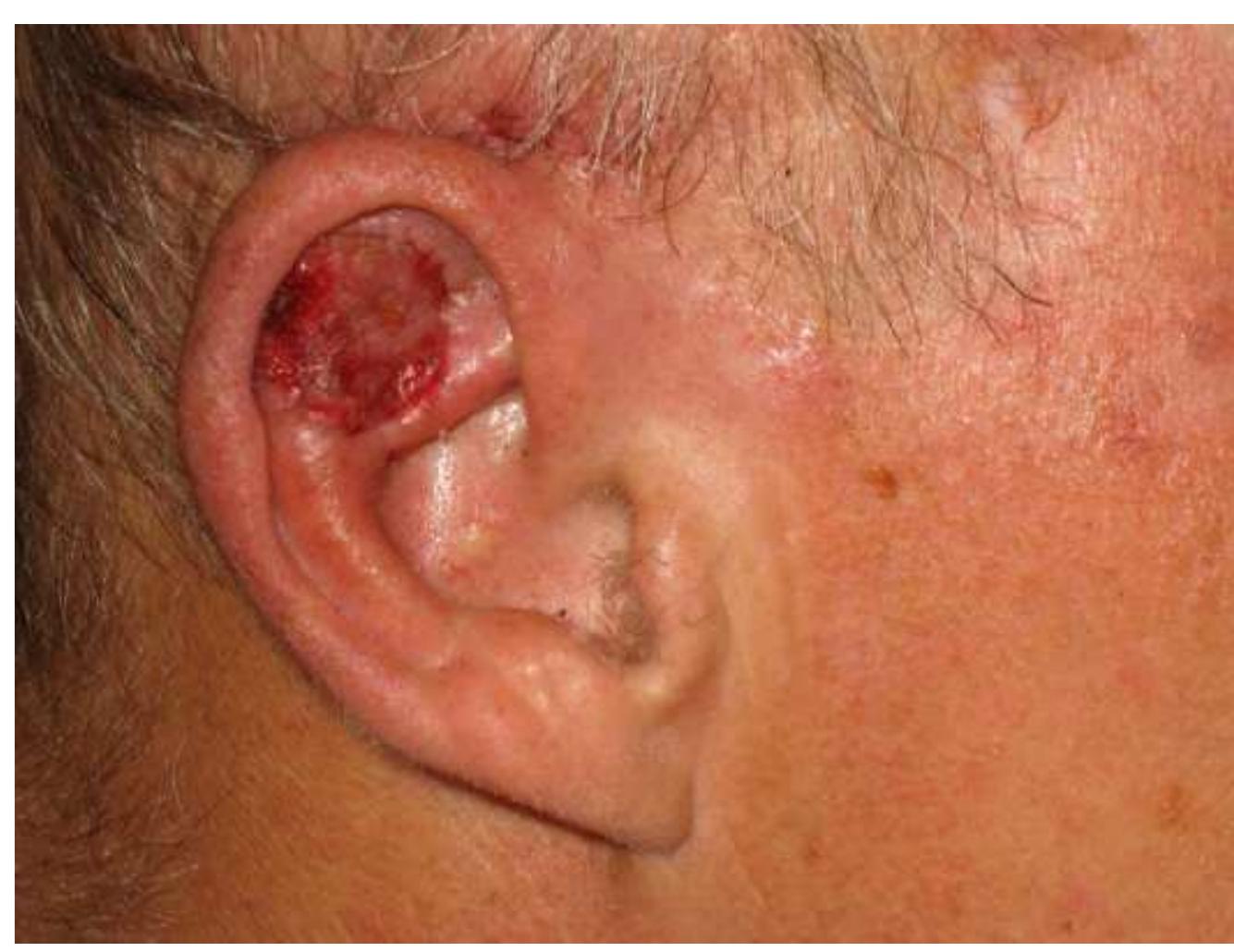 Mohs defect of the scaphoid fossa and superior antihelix