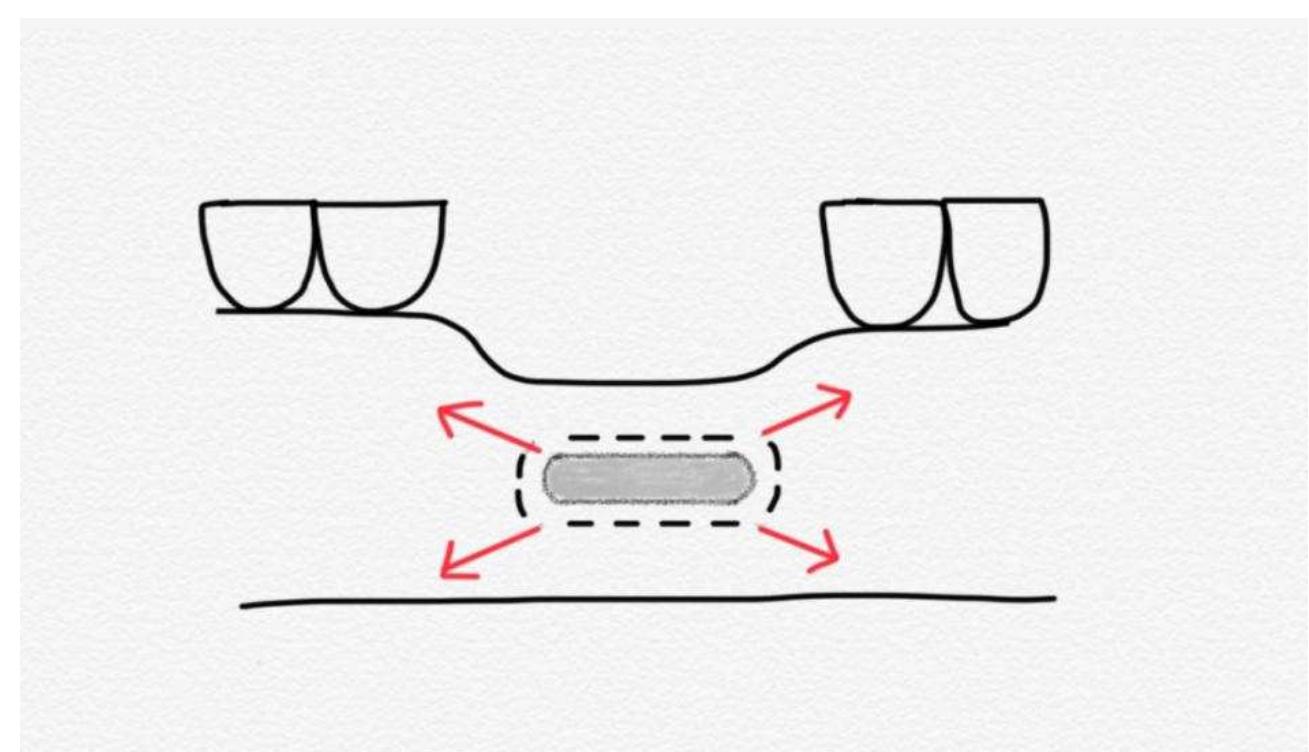 (g):- autonomous growth of tissue expander.