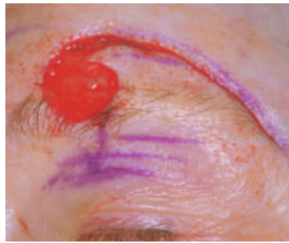 Defect following mohs micrographic surgery.