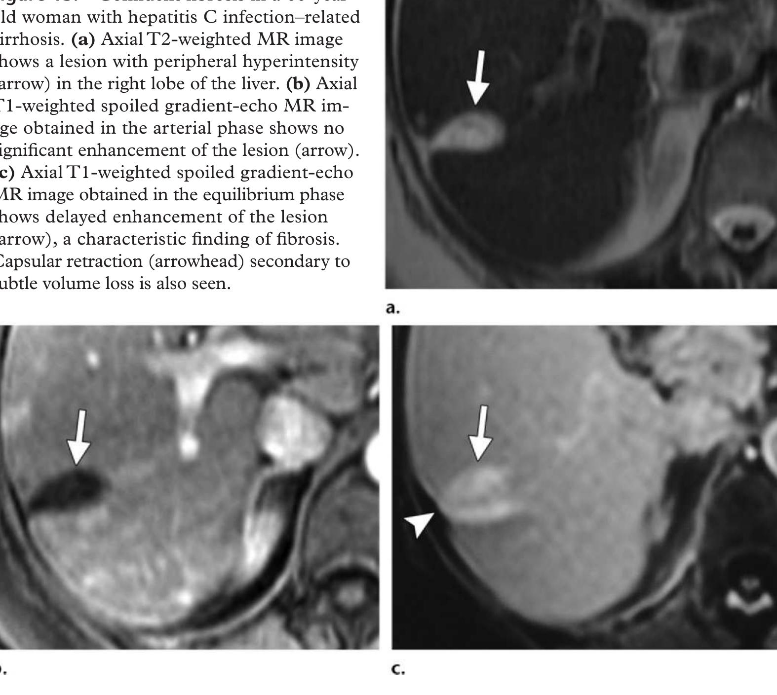 Figure 12 - MR Imaging of Hypervascular Lesions in the