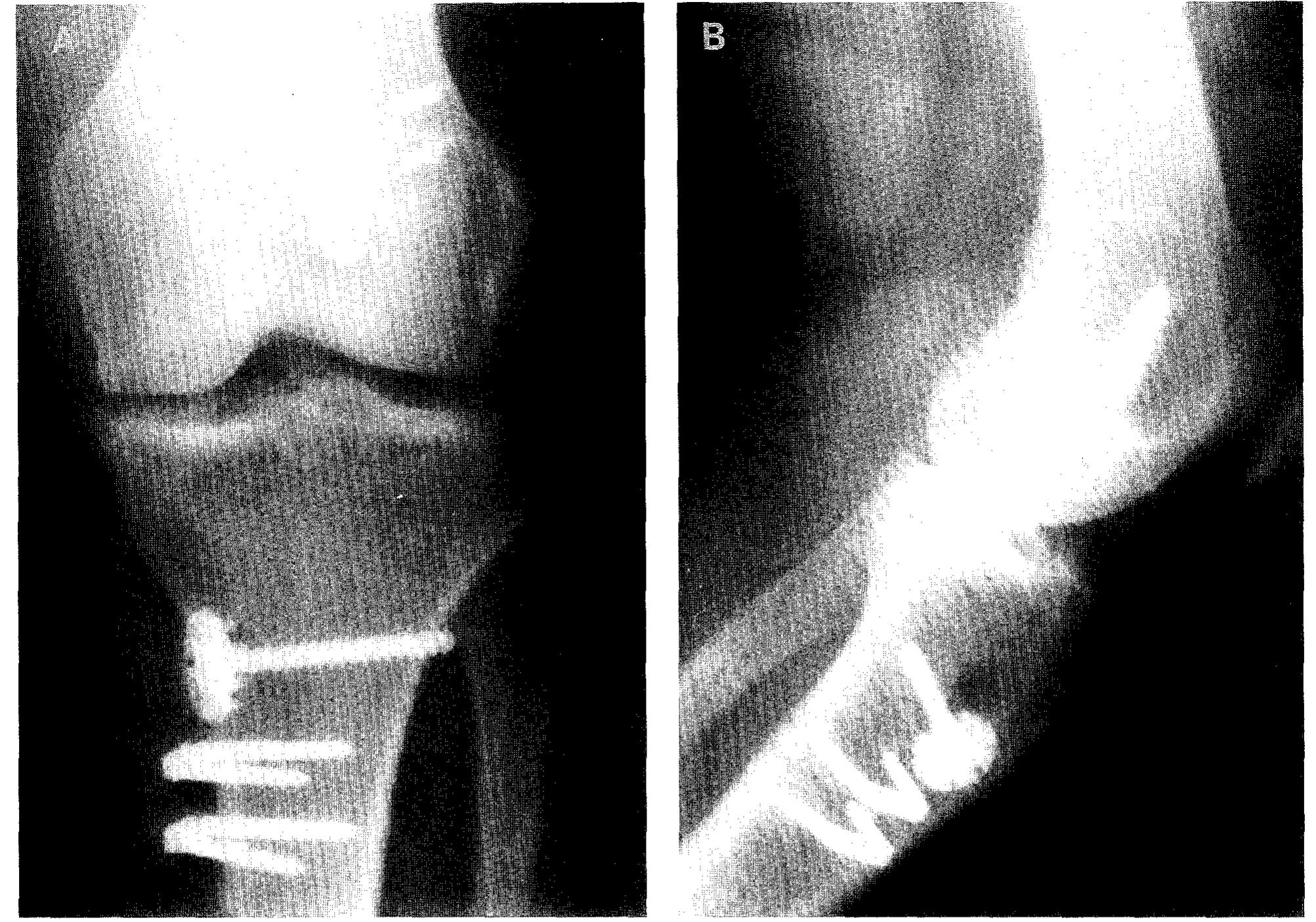 (a) anterior-posterior and (b) lateral radiographs of a