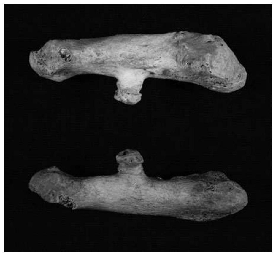 Two views of the right fifth metatarsal with a growth