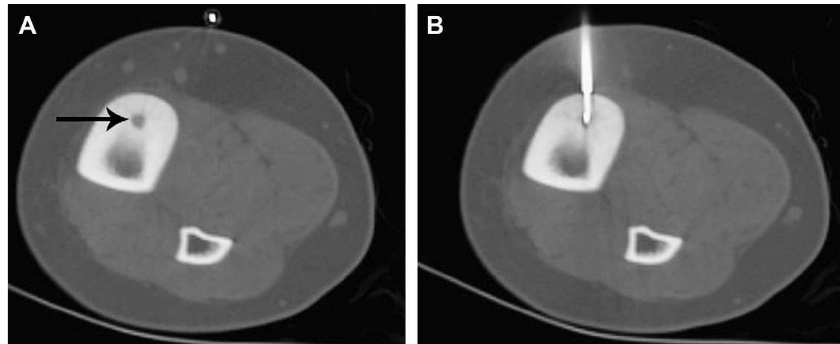 (a) classical osteoid osteoma of the anterior tibia shows