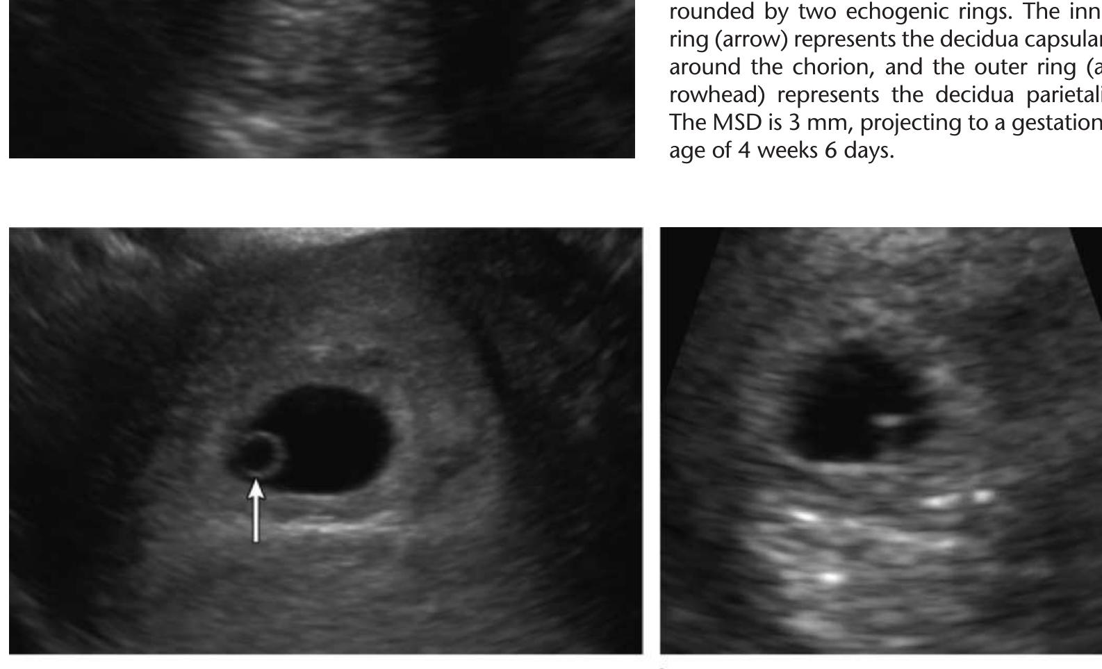 Endovaginal us images show a normal yolk sac at varying