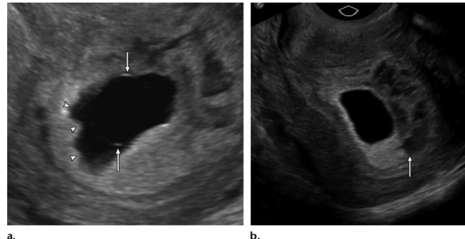 Endovaginal us images show findings suspicious for but not