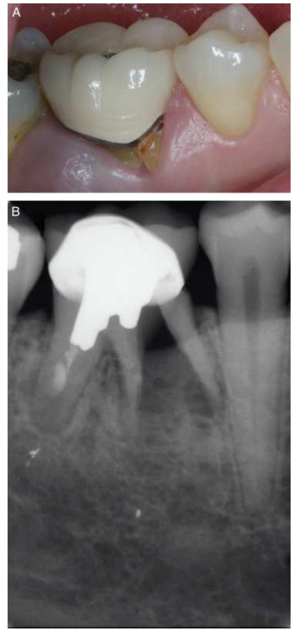 This mandibular first molar has a history of prior root