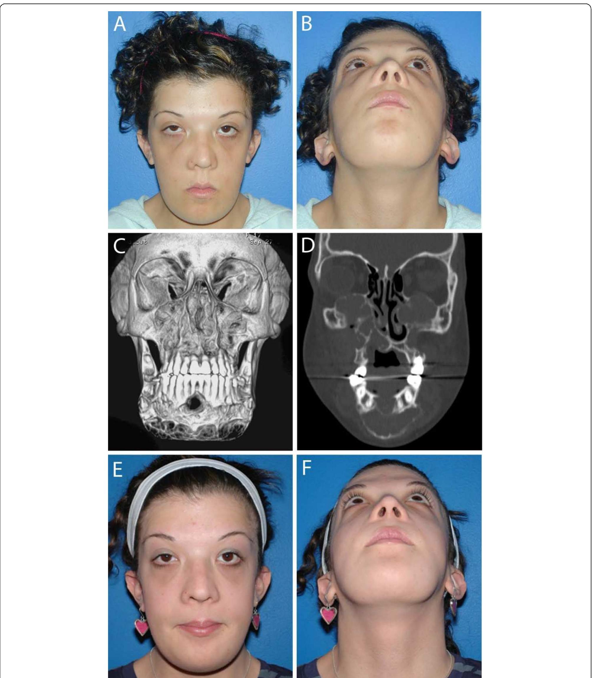 Noonan/multiple giant cell lesion syndrome. a 20-year old