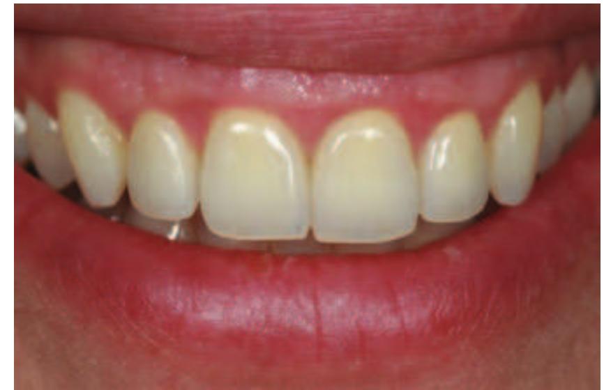 (PDF) Gingival Zenith Positions and Levels of the Maxillary Anterior ...