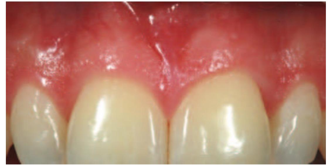 (PDF) Gingival Zenith Positions and Levels of the Maxillary Anterior ...