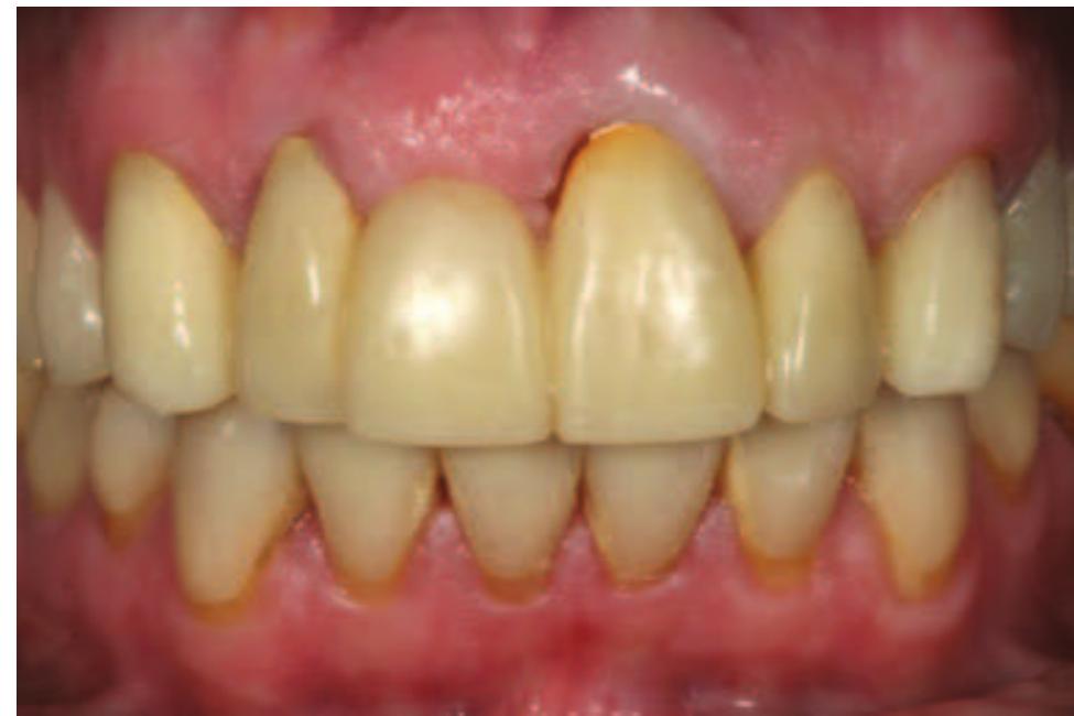 Intraoral view of provisional restorations on teeth #6 to 11