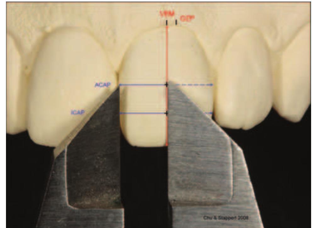 (PDF) Gingival Zenith Positions and Levels of the Maxillary Anterior ...