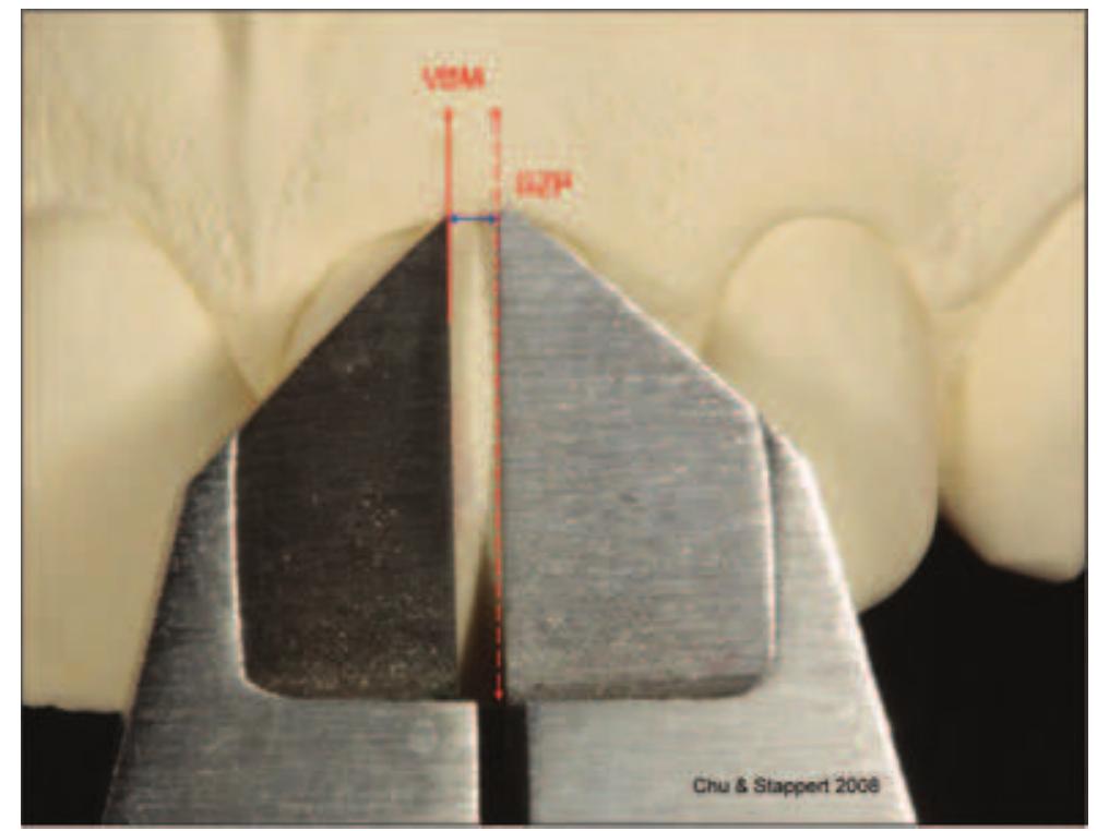 (PDF) Gingival Zenith Positions and Levels of the Maxillary Anterior ...