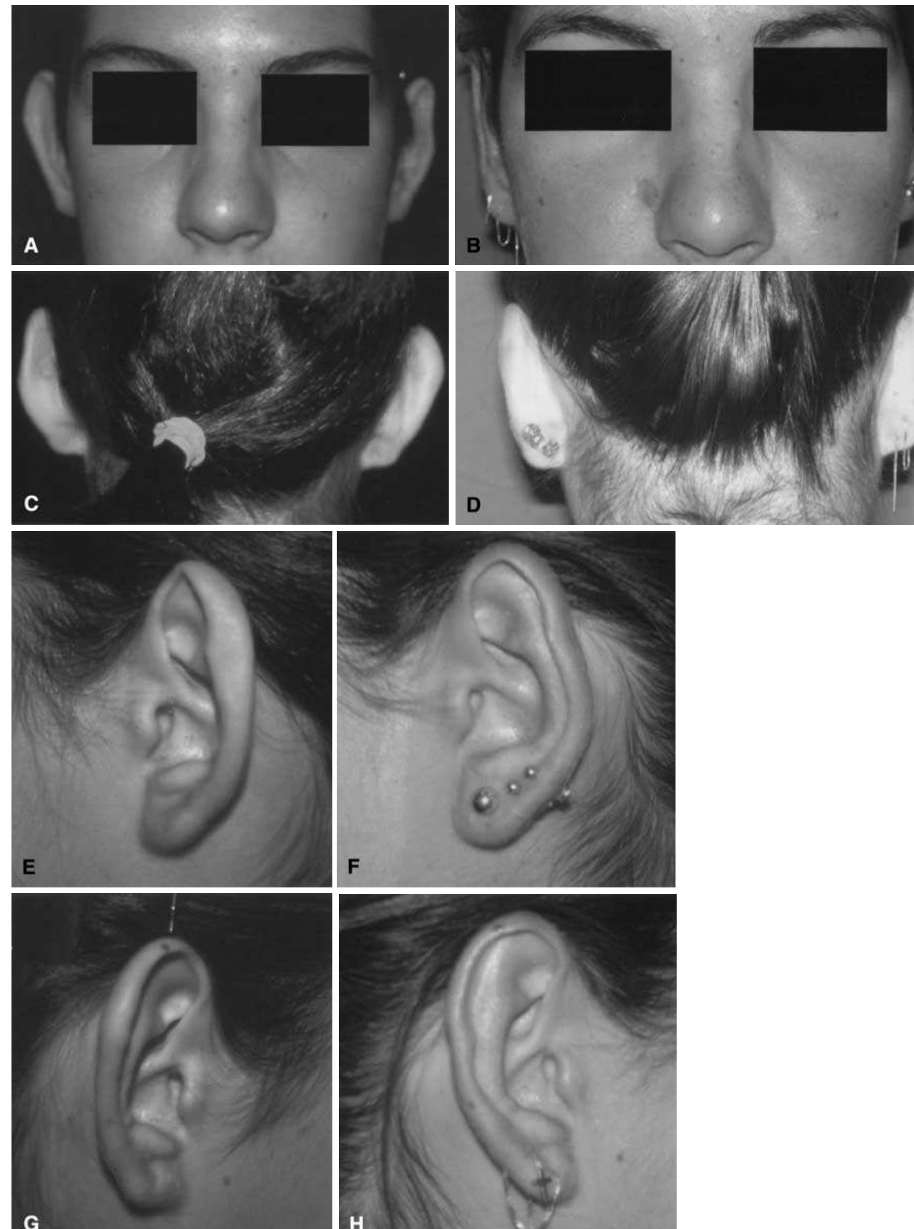 Figure 2 - Anterior Scoring of the Upper Helical Cartilage