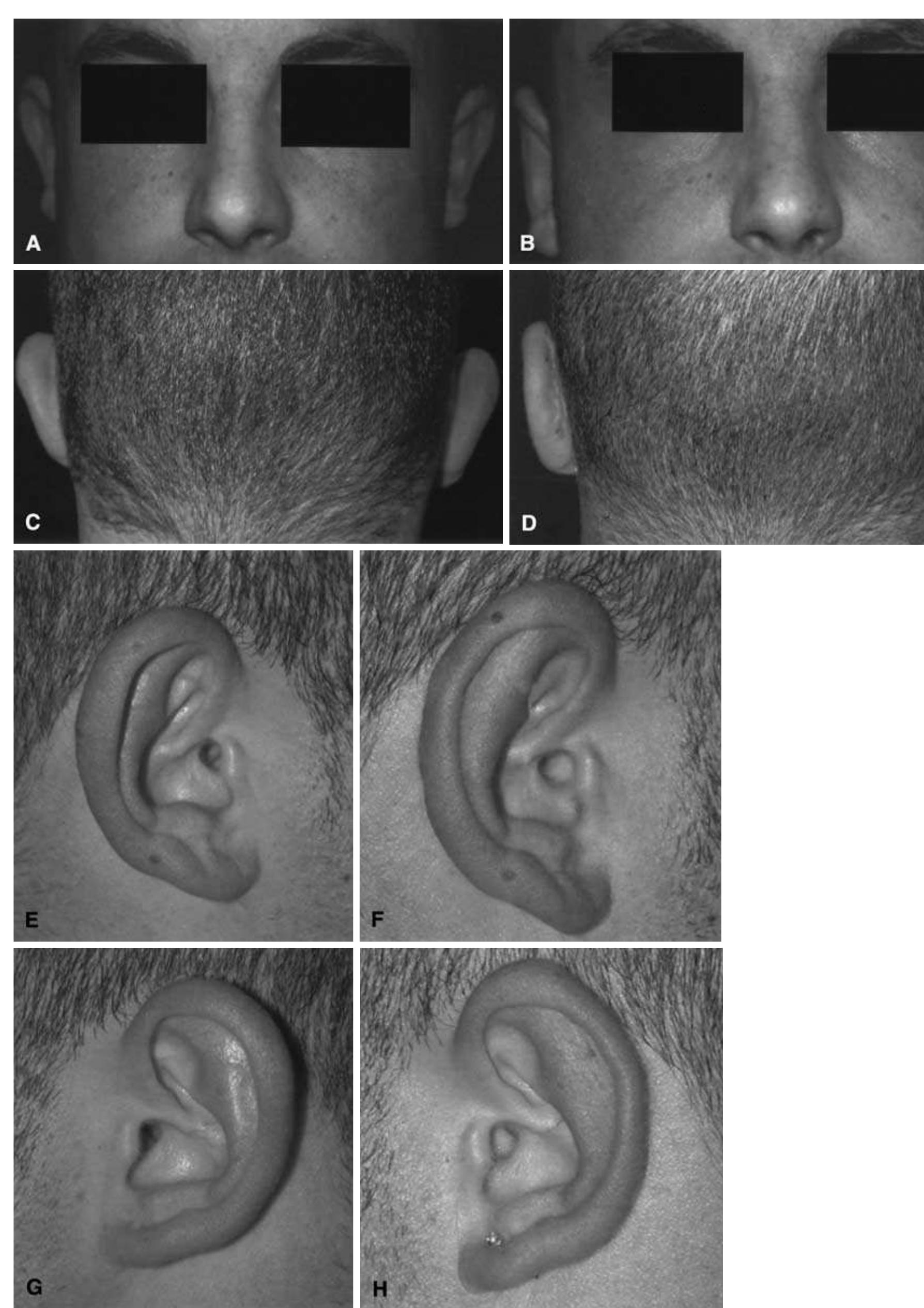 Figure 3 - Anterior Scoring of the Upper Helical Cartilage