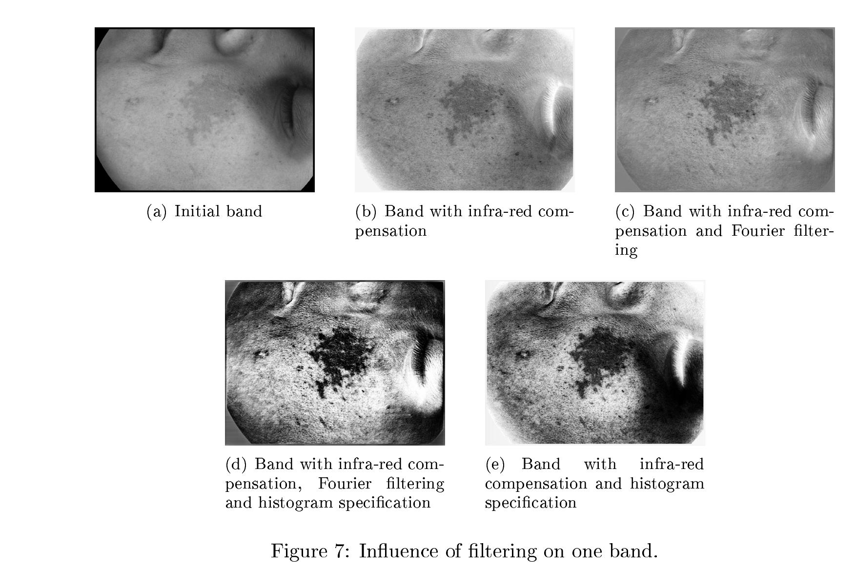 Figure 9 - Classification of skin hyper-pigmentation lesions