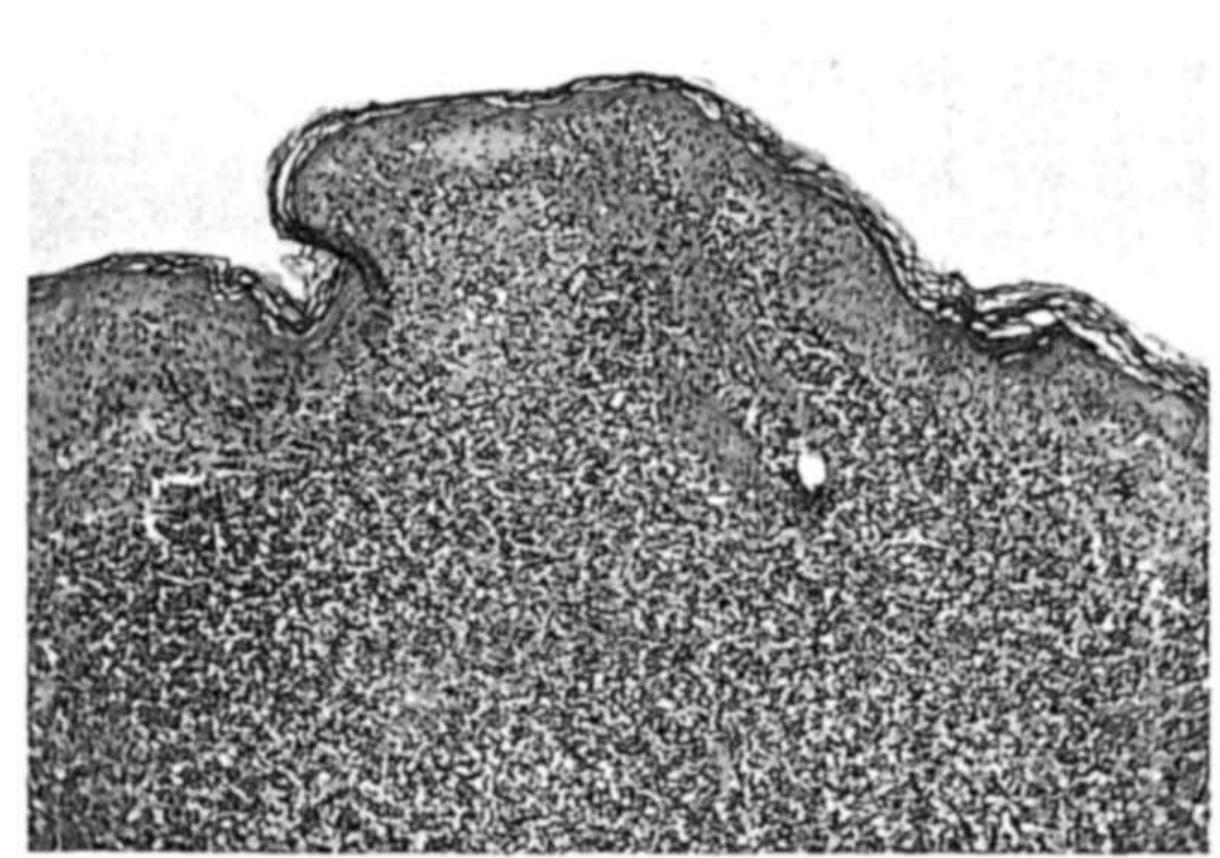 Vegetating iododerma with systernic disease 419