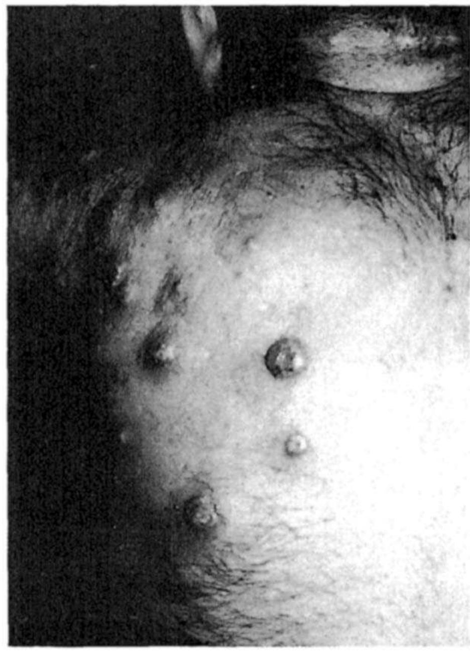Case 2. nodular, vegetating, and ulcerative lesions on left