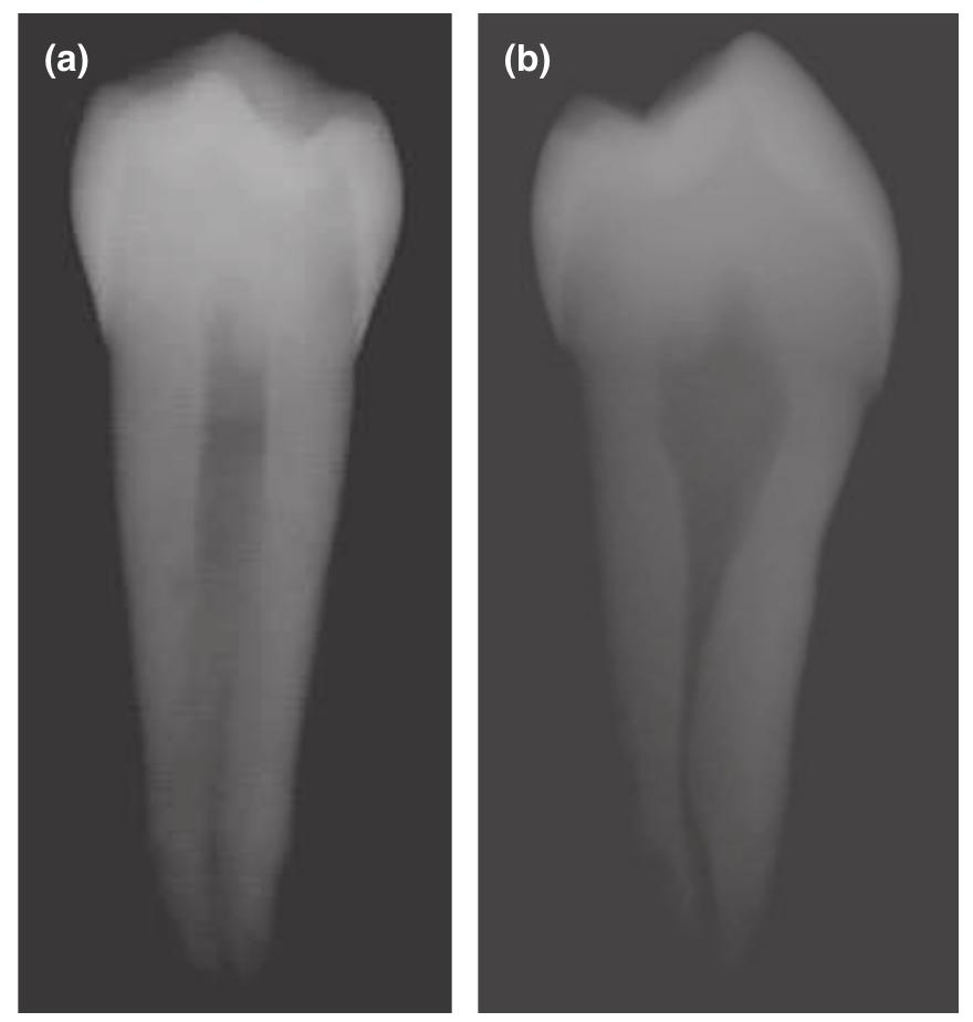 Radiographs of mandibular second premolar shown in fig. 6: