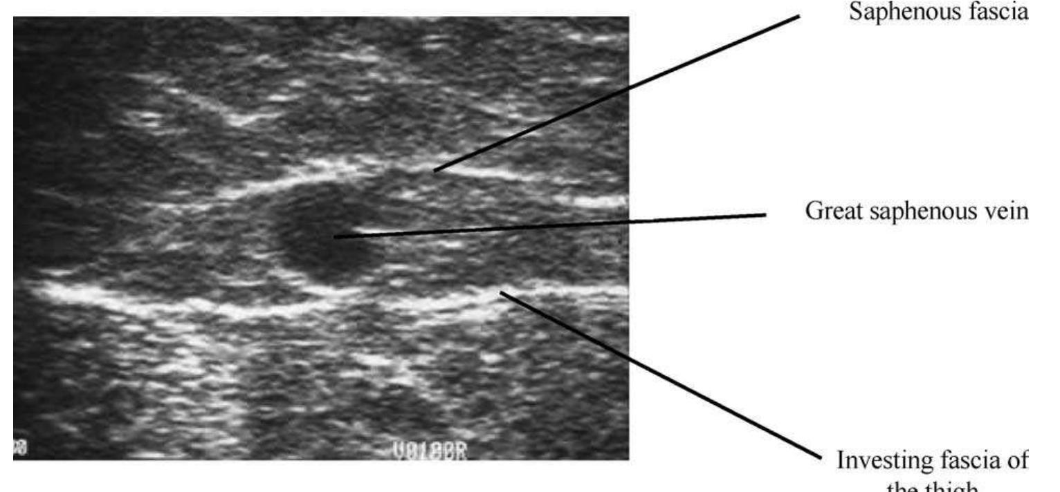 The ‘saphenous eye’—a transverse ultrasound image of the gsv