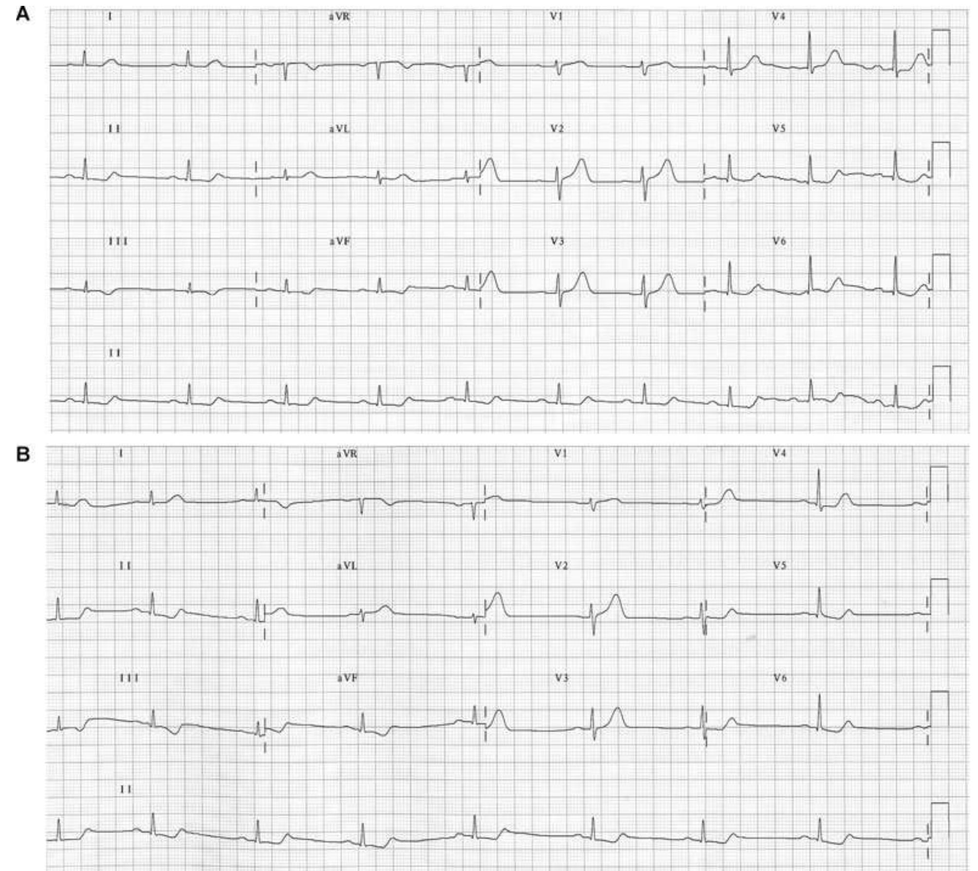 (a) electrocardiogram of a patient with acute coronary