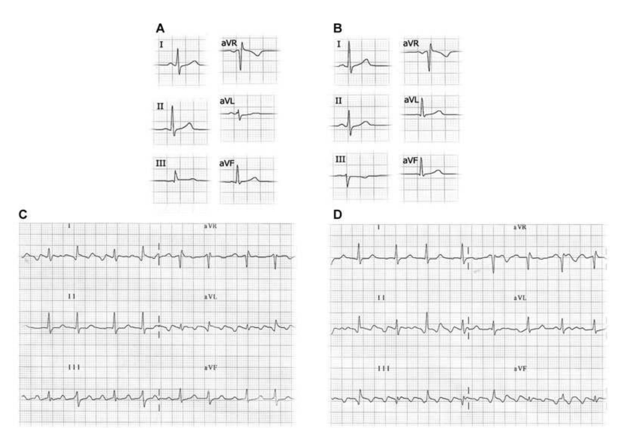 (a) electrocardiogram recorded with left leg—left arm