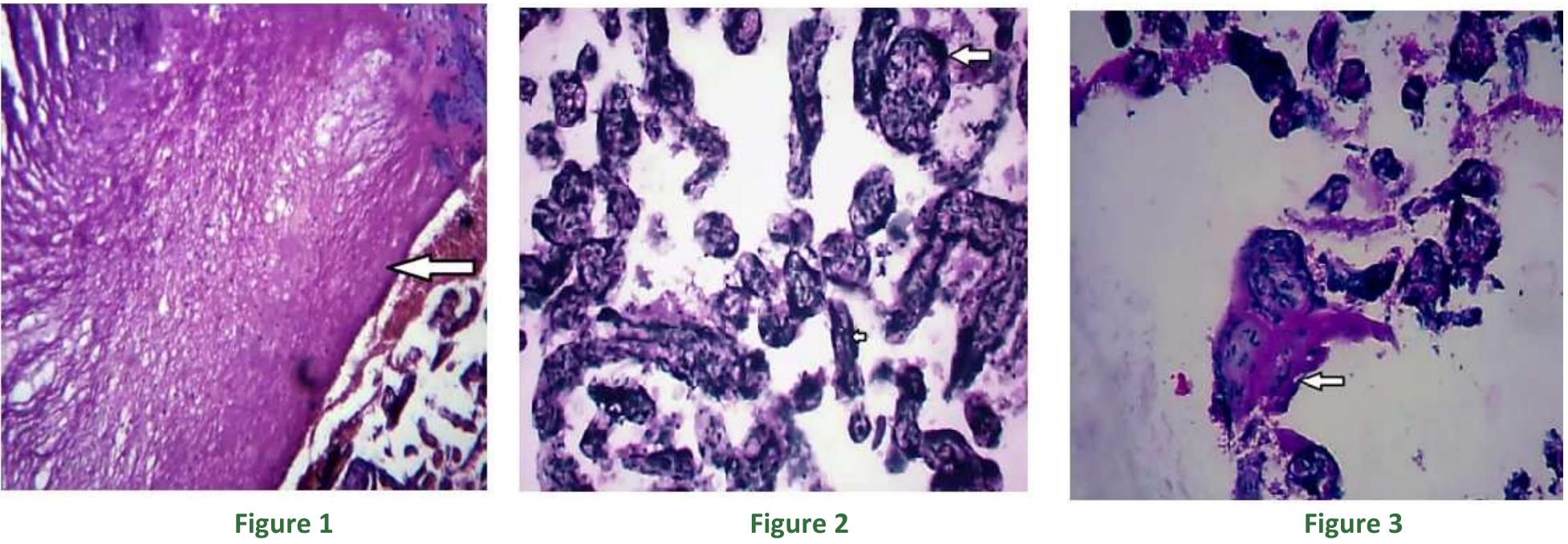 Legend — figure 1: shows areas of necrosis in the