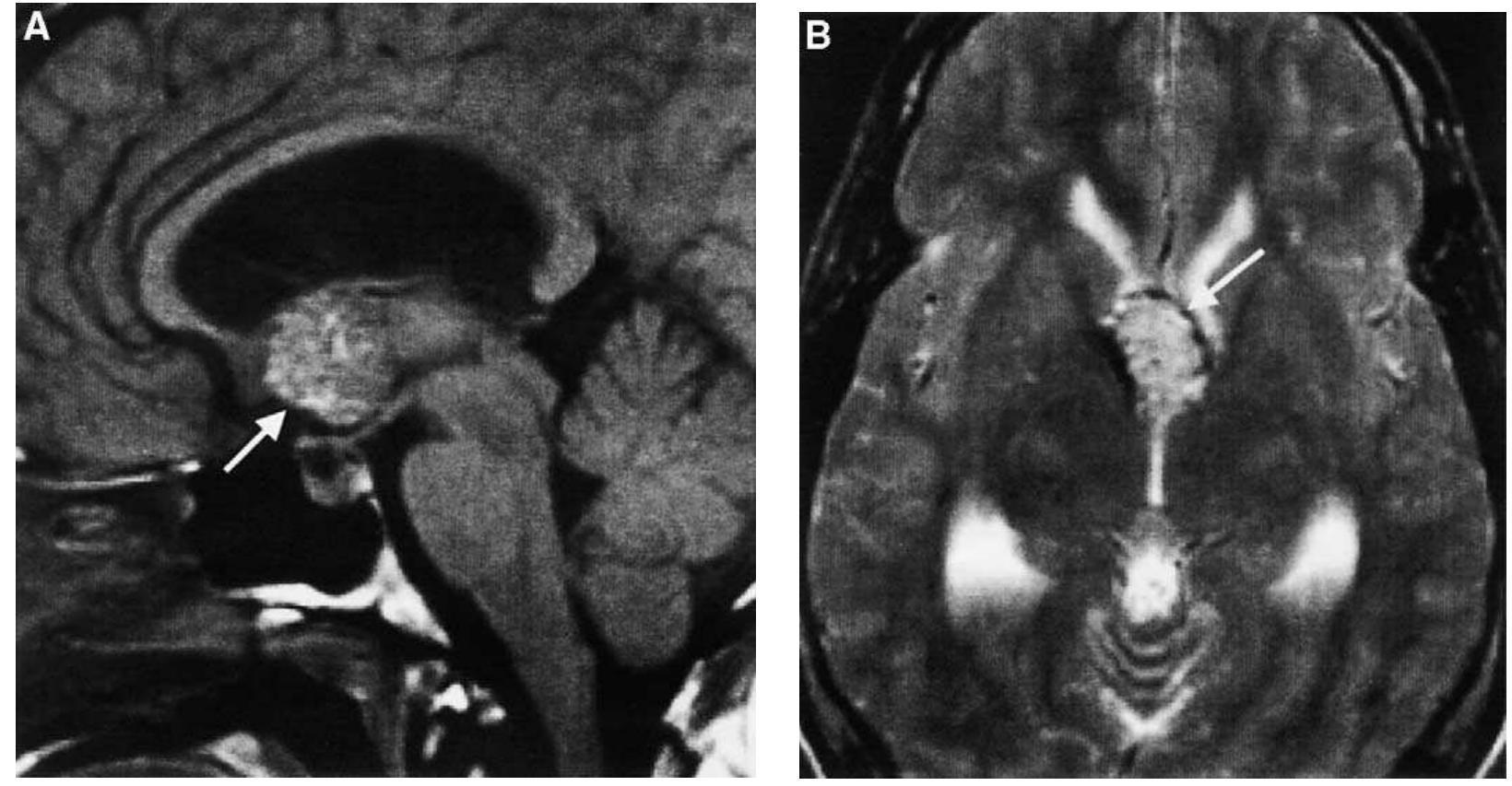 Intraventricular cm. (a) sagittal tl weighted mr imaging