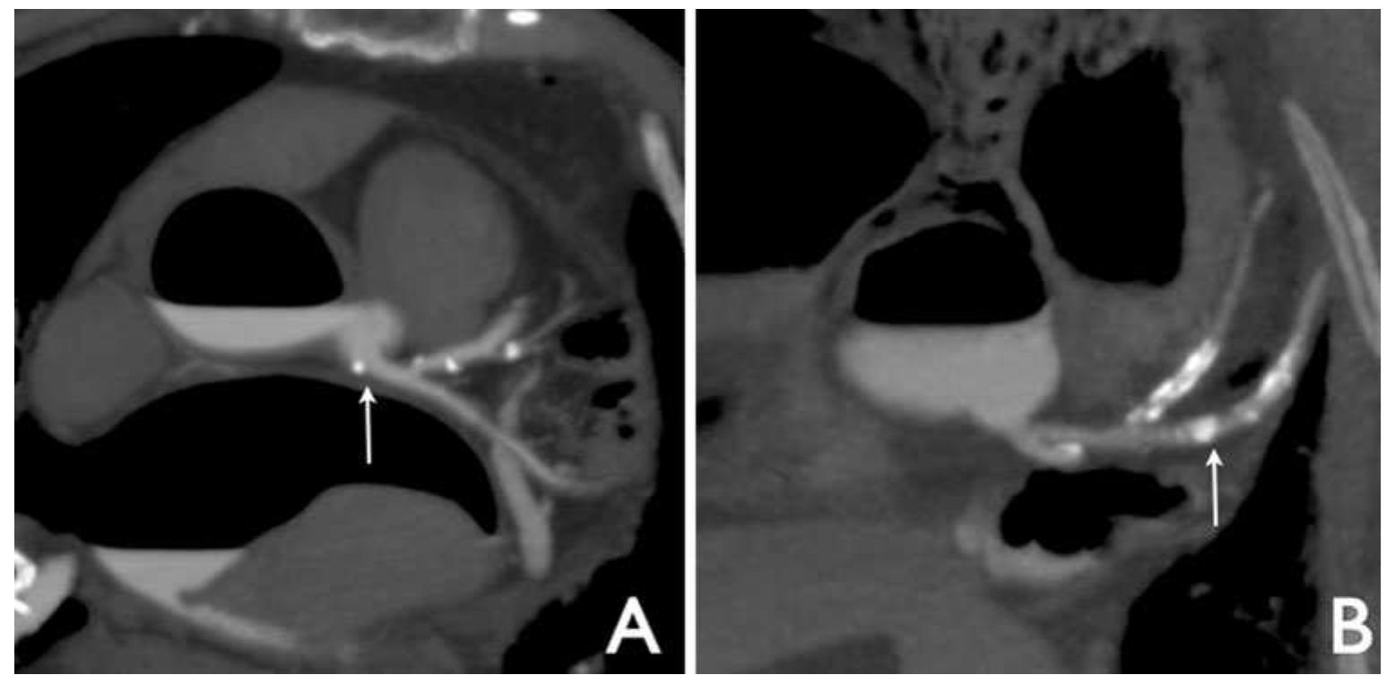 Mpr images of the left coronary arteries demonstrating minor