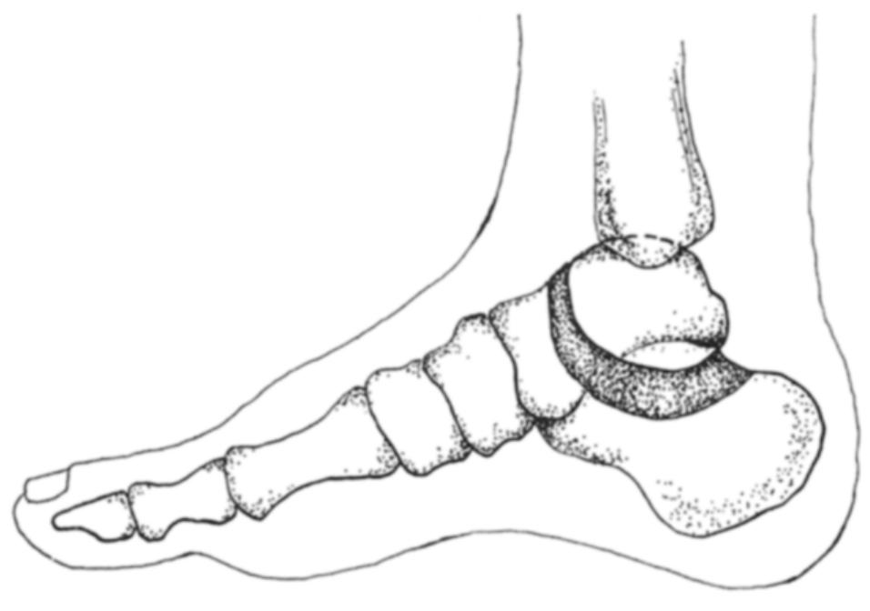 Schematic drawing of u-osteotomy. figure 2 schematic drawing