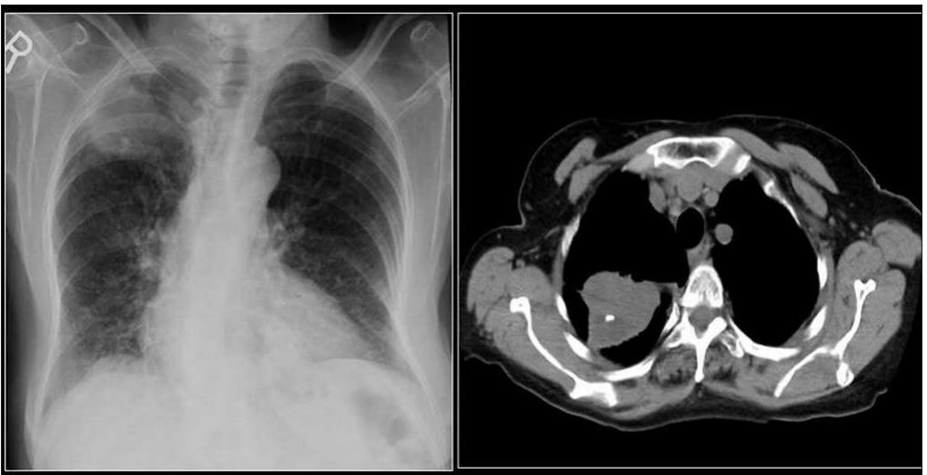 A chest radiograph and axial ct scan shows a dense nidus of