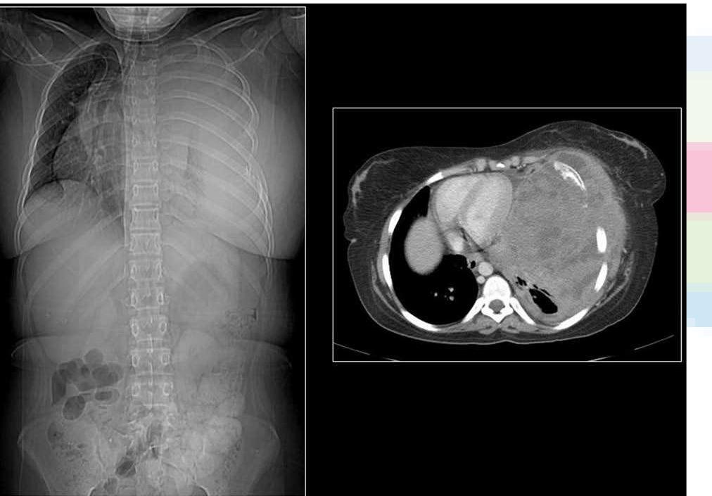 A ewing’s sarcoma of a rib invading the left pleura and left