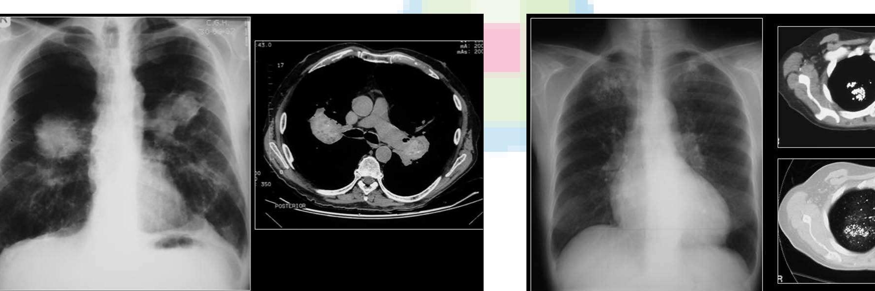 Chest radiograph and an axial ct scan shows calcification